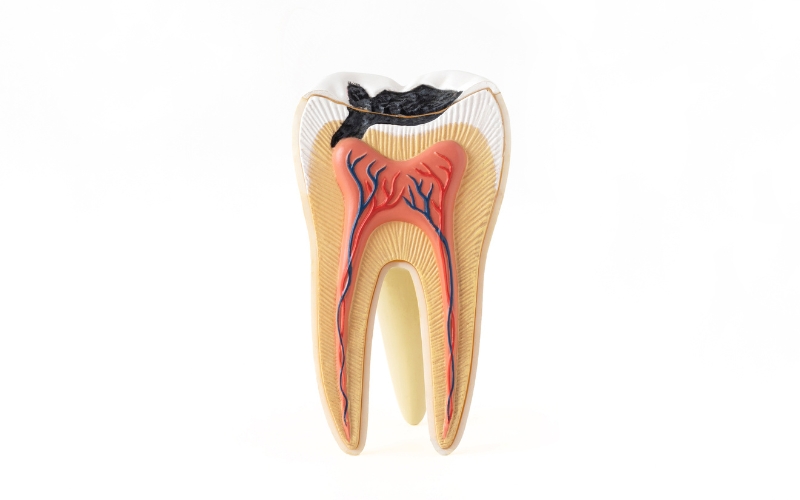 Speedy Root Canal Recovery: Proven Tips in Your Ultimate Guide