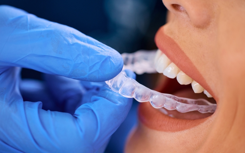 Transform Your Smile with the Magic of ClearCorrect Braces